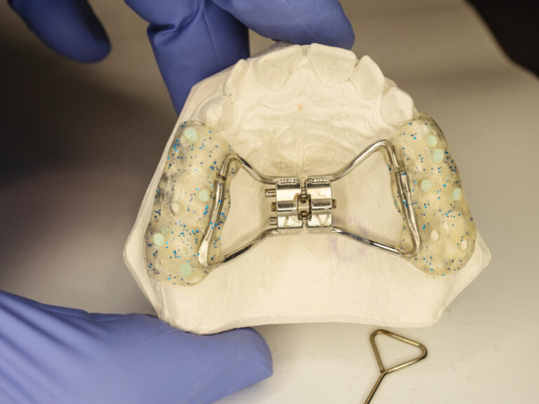 Understanding Rapid Palatal Expanders in Orthodontic Treatment - Storms ...